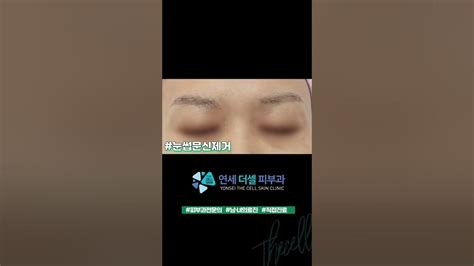 자연스럽게 눈썹문신 지우기 😘 눈썹문신제거 전 후 눈썹문신제거 문신제거 Shorts Youtube