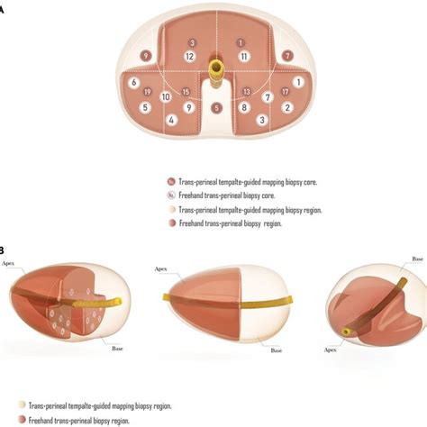 A Trans Perineal Template Guided Mapping Biopsy B Freehand