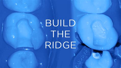 Closing The Class Ii Proximal Box Spear Education