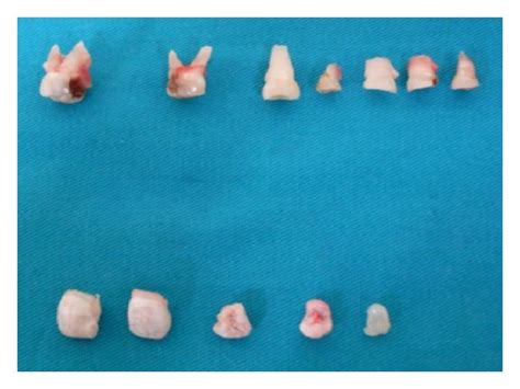 Postsurgical Photographs Showing Extracted Teeth A Maxillary Download Scientific Diagram