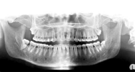 Radiology Panoramic Technique And Common Errors Flashcards Quizlet