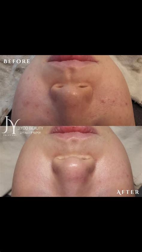 김천피부관리 김천no1피부 지유뷰티 원장 이지유 여드름 L 모공 L 기미 잡티 L 흉터 L 윤곽 L 속눈썹펌 김천no1