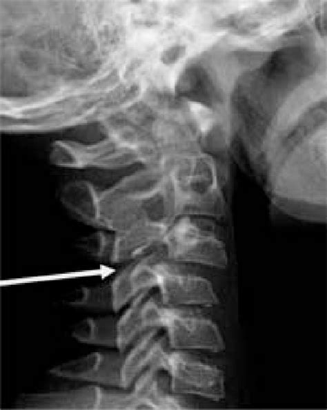 Unilateral Facet Dislocation Cervical Spine Injuries Part Ii 2012 07 02 Ahc Media