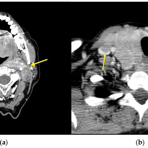 Axial Ct Scan Image A Neck Recurrence Arrow Of Dtc Affecting The Download Scientific