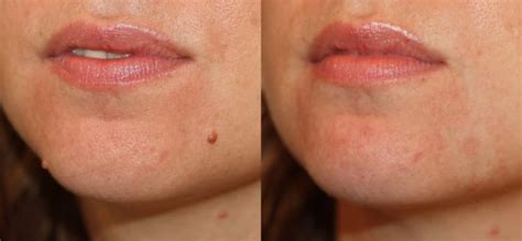 Moles Cysts Warts Skin Tags Skin Surgery Laser Clinic