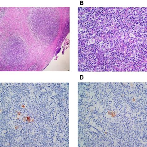 Nodular Sclerosis Classic Hodgkin Lymphoma A Nodular Growth Pattern Download Scientific