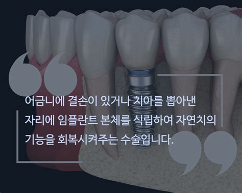 어금니 임플란트 오플란트치과의원