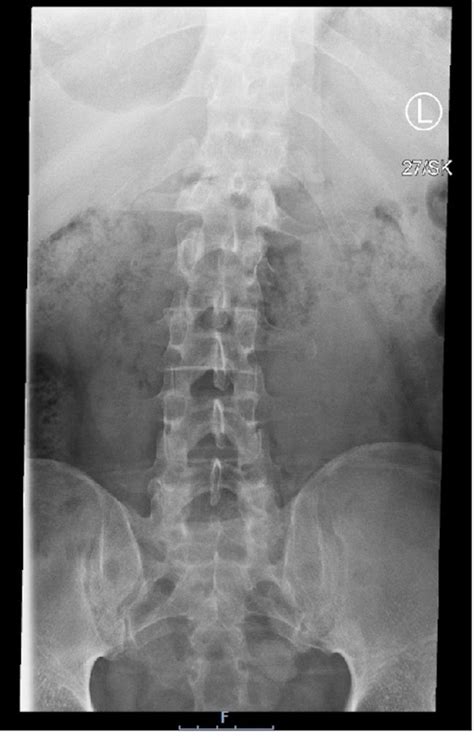 Psoas Abscess X Ray