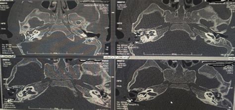 Hrct Scan Imaging Of The Temporal Bone Post Cochlear Implant Right