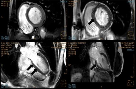 case 1 magnetic resonance imaging contrast linear enhancement in