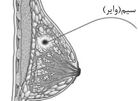 وایرگذاری در پستان چیست؟ کلینیک تصویربرداری صبا دکتر سفیدبخت