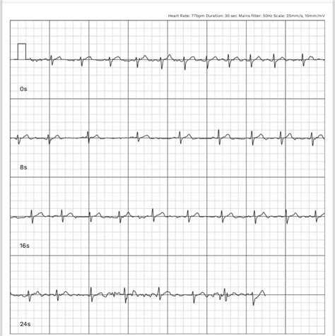 Afib Pacs Or Something Else Rafib
