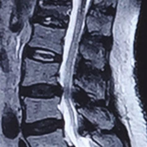Postoperative 3d Ct Images After Anterior Debridement L1 Corpectomy Download Scientific