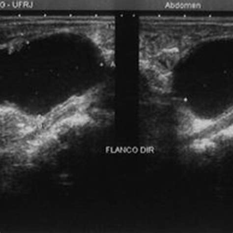 Full Article Duodenal Duplication Intestinal Malrotation And Volvulus An Unusual Cause Of