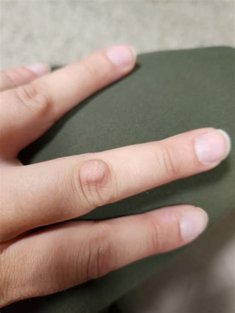 Ganglion Cyst Home Remedies Rautoimmune