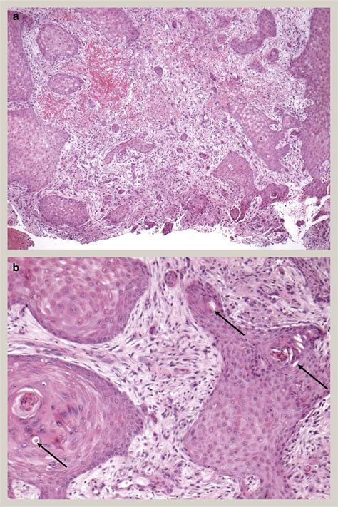 Pyoderma Gangrenosum And Pseudoepitheliomatous Hyperplasia A Poorly Recognized Association