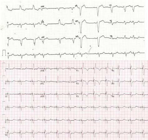 Case Demonstrating Left Conduction System Pacing Above Intrinsic