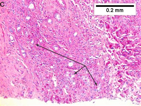 Cholangiocarcinoma Libre Pathology