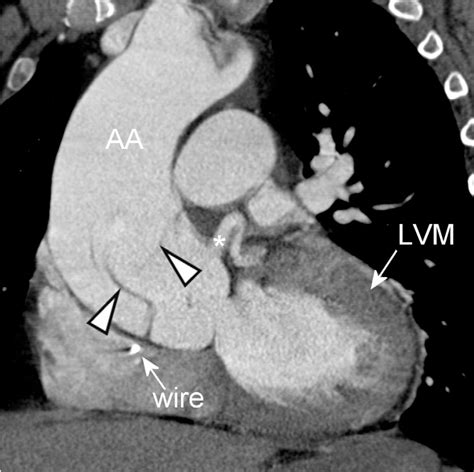 Figure 1 From Aortic Dissection With Sheared Off Intimal Flap