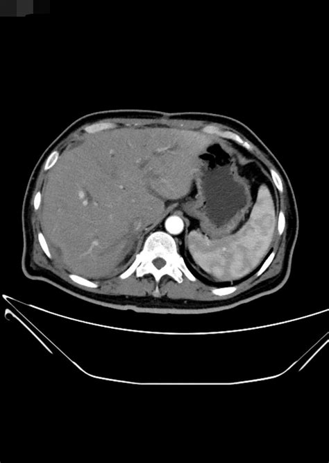 Transverse Section Of Ct Scan Showing Dilatation Of Intrahepatic Bile