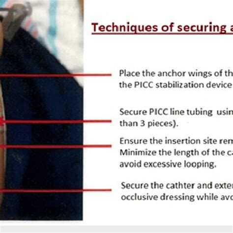 1 Fr PICC Line Securing Techniques Image Credit Palanikumar Download Scientific Diagram