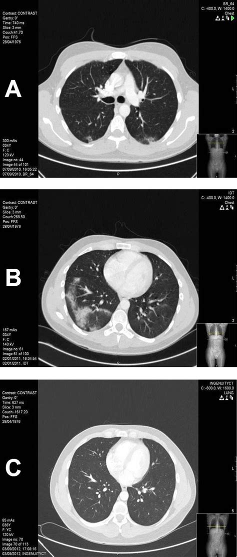 A Ct Scan Following Completion Of Bep Regimen Cumulative Bleomycin