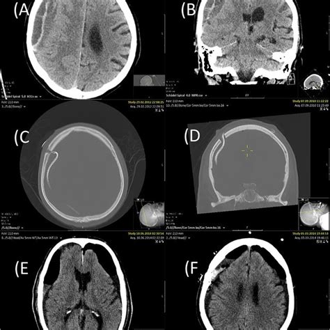 A B Septations Within The Haematoma C A Case Of Misplacement And