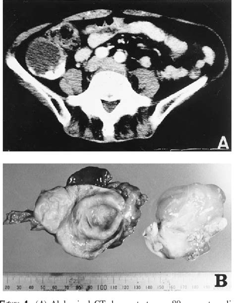 Figure 1 From Can Cea Predict Malignancy Of Cystic Tumor Of The