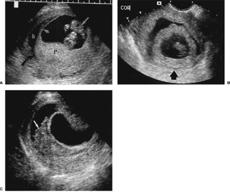 First Trimester Complications Flashcards Quizlet