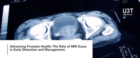 Advancing Prostate Health The Role Of Mri Scans In Early Detection And