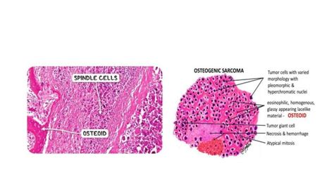 Osteoid Osteoma And Osteoid Sarcoma Pptx