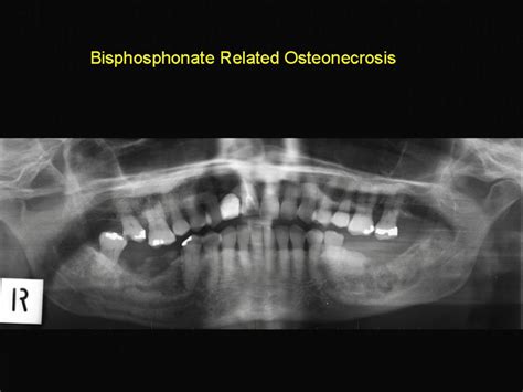 Opg Of A 76 Year Old Female With Jaw Swelling There Is Extensive