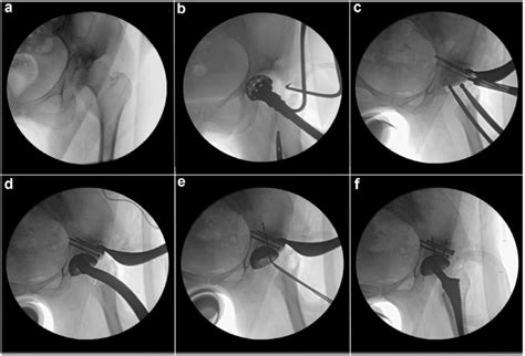 Intraoperative Fluoroscopy Depicting Surgical Technique A