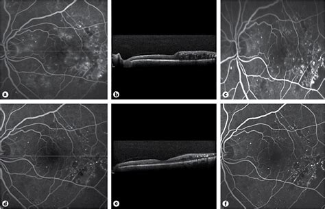 Patient From The Nonischemic Group A C Fa With Simultaneous Oct And