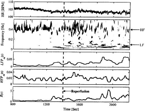 Wavelet Analysis Of Patient T26 Inferoporterior Wall Myocardial Download Scientific Diagram