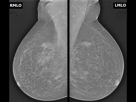 Atlas Of Breast Cancer Early Detection