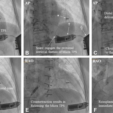 Fluoroscopic Views Of Leadless Pacemaker Retrieval Download