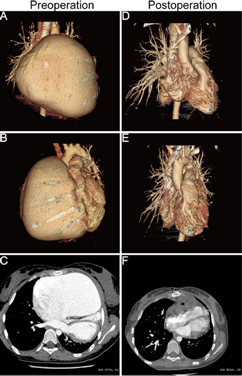Figure 1 From A Case Of Giant Right Atrium Diverticulum With Atrial
