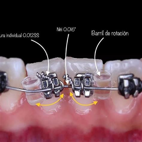 2pcs Bag Orthodontic Rotation Wedges Torsion Pad Dental Rotating Wedge