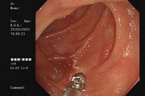 Live Hookworms Photographed In Womans Intestine