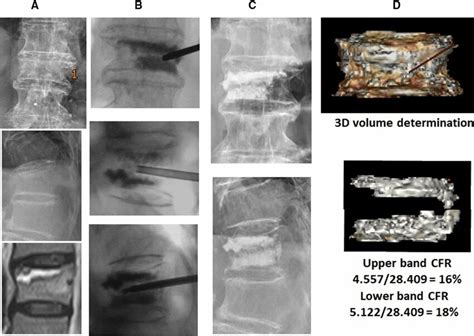 Case Demonstrated Determination Of Cement Filling Rate Cfr For Double Download Scientific