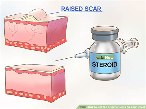 How To Get Rid Of Acne Scars On Your Chest With Pictures