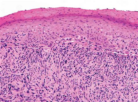 What Is Spindle Cell Sarcoma Klarity Health Library