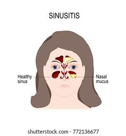 Sinusitis Sinus Infection Inflammation Sinuses Rhinosinusitis Stock