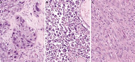 Thyroid Cancer Cells
