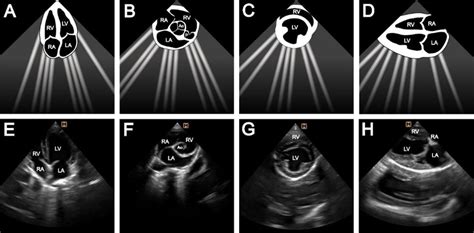 A Schematic Ilustration Of The 4 Adapted Echocardiographic Views Used Download Scientific