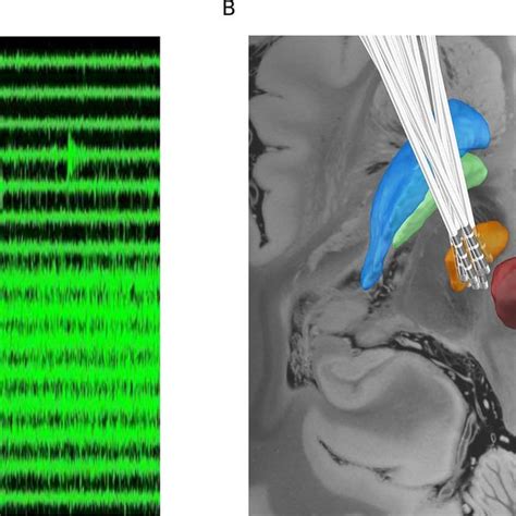 A Raw Microelectrode Recordings Mer Obtained From Different Depth Download Scientific
