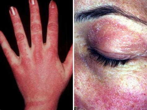 What Is The Main Cause Of Dermatomyositis Symptoms And Prevention