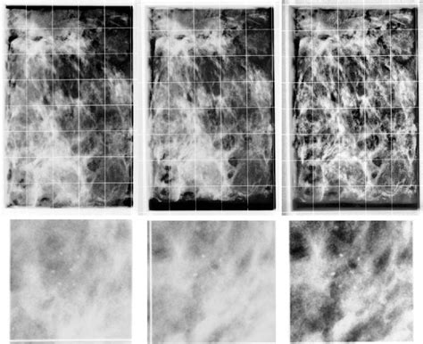 Figure 1 From Detection Of Simulated Microcalcifications In Fixed