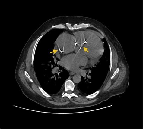 Computed Tomography Of Chest Download Scientific Diagram